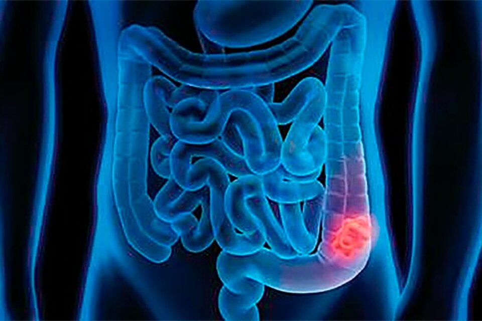 ¿Qué es un pólipo intestinal? | La afección que le detectaron a ...